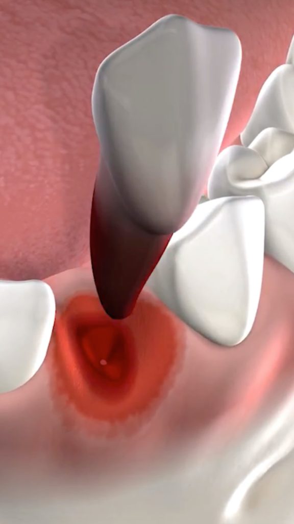 Oral Surgeon Springfield | Oral & Facial Surgeons of Illinois, located ...