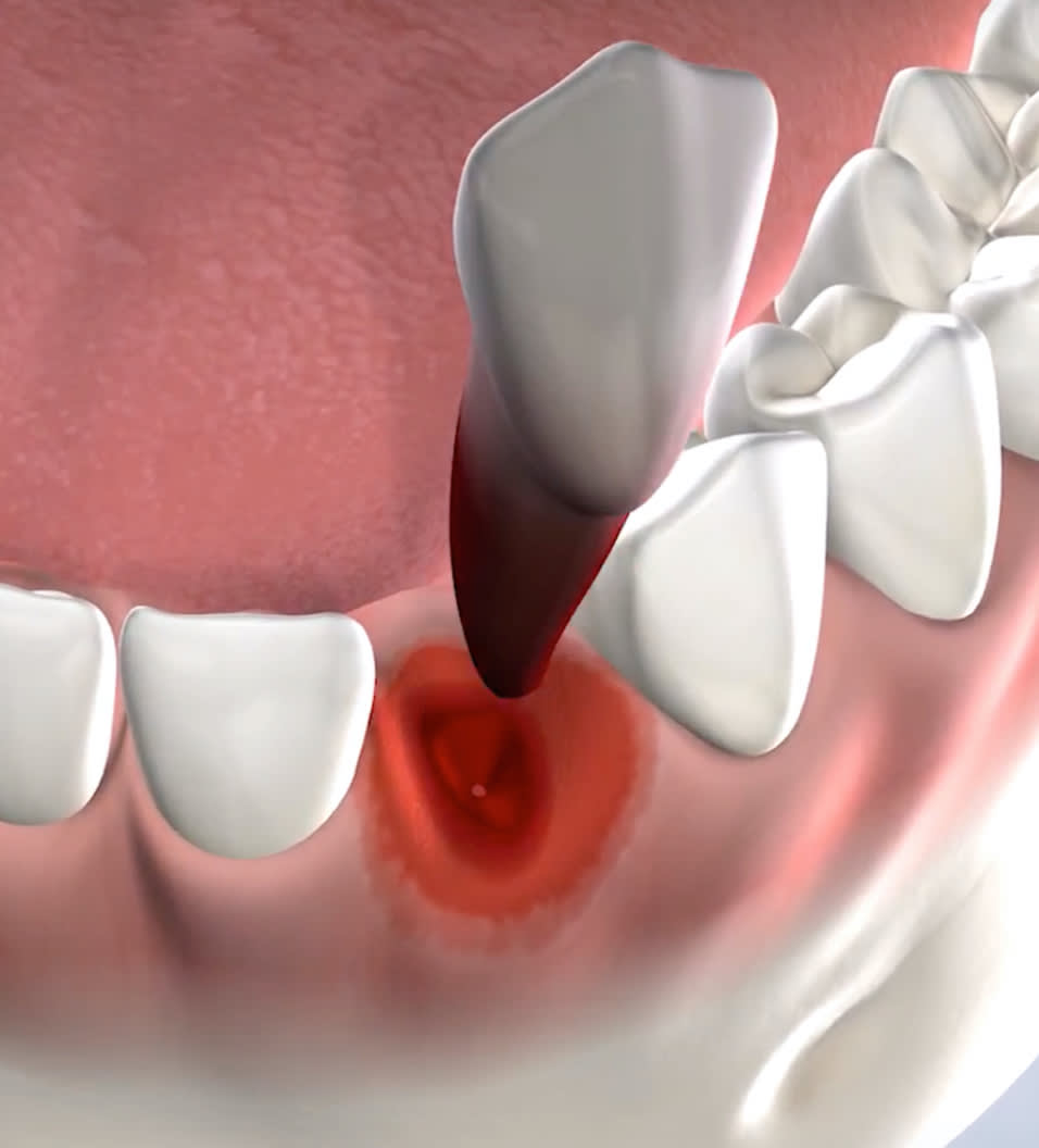 Oral Surgeon Springfield | Oral & Facial Surgeons of Illinois, located ...